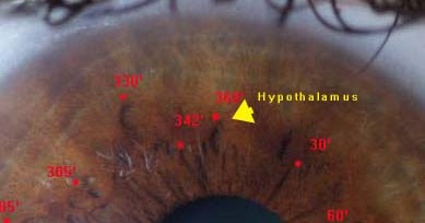Modern & Multidimensional Iridology: Closed Lacuna Located at External ...
