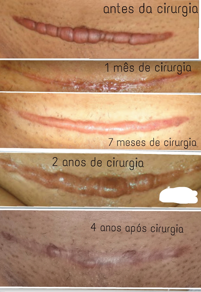 Qual A Diferença Entre Queloide E Cicatriz Hipertrofica - Notícias e ...