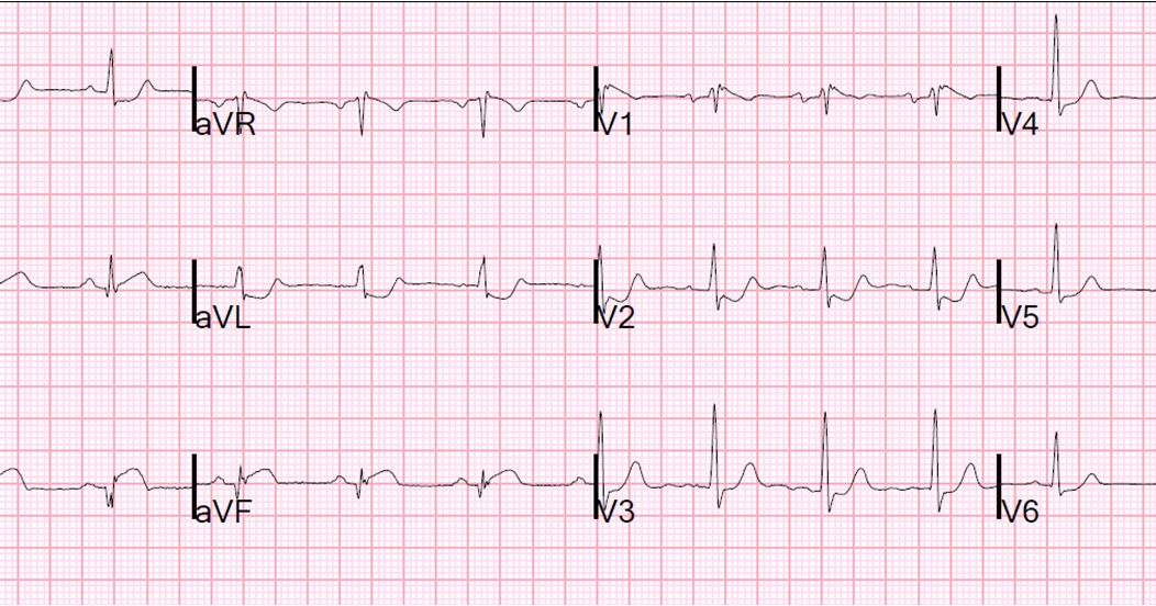 Dr. Smith's ECG Blog: Inferior and Posterior STEMI. What else?