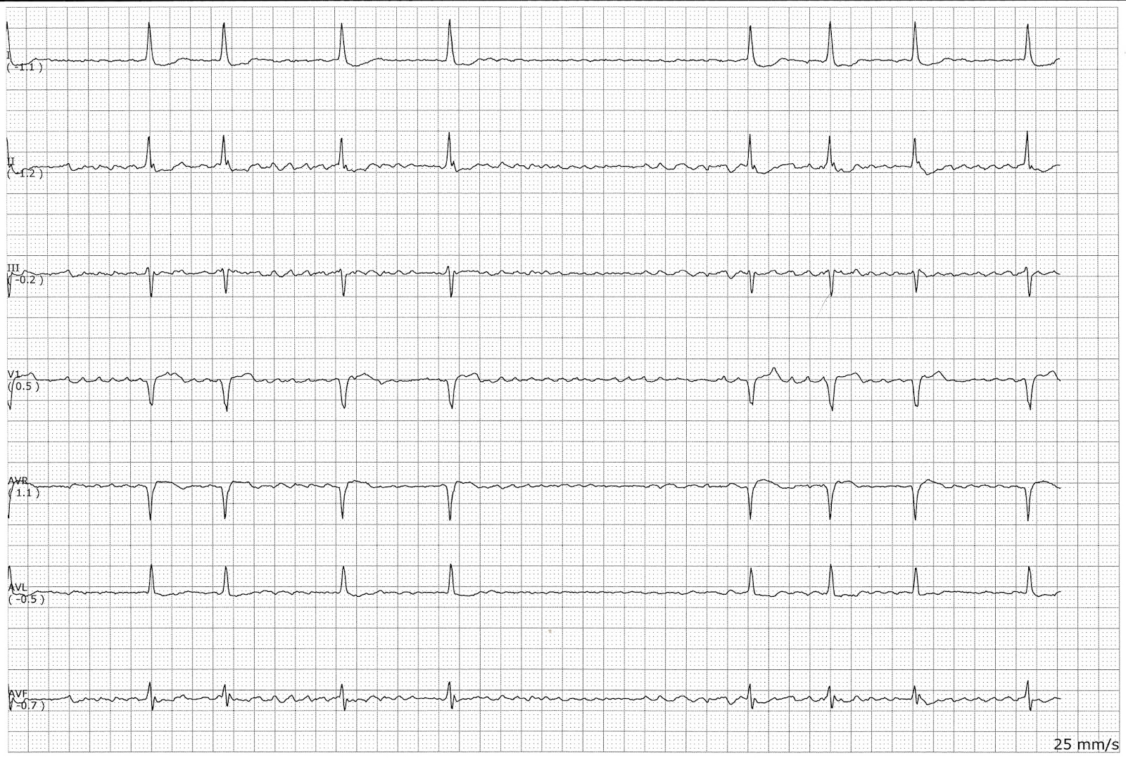 Atrial Fibrillation with Slow Ventricular Response