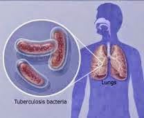 Microbiologia: Mycobacterium Tuberculosis