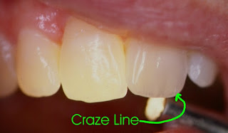 Dental Hour with Dr. Suffoletta: Ways to Fix a Broken Tooth at the Dentist