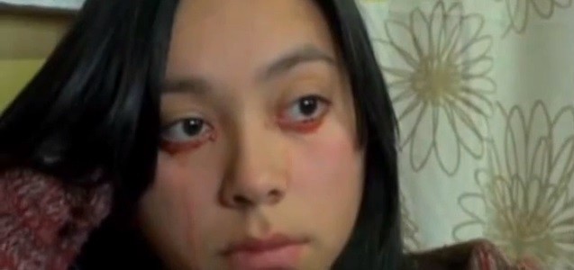 The girl who cries tears of blood (Haemolacria)