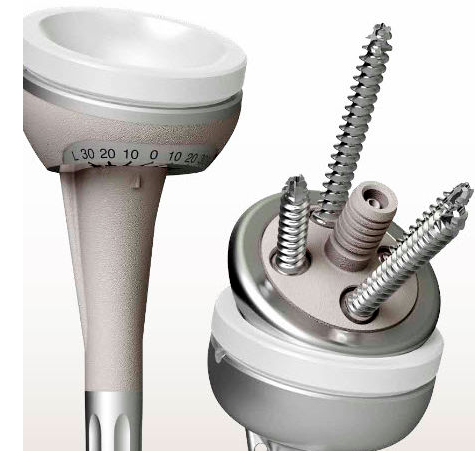 UW Shoulder and Elbow Academy: Reverse total shoulder - progressive ...