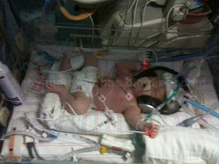 Baby Andrew: ECMO and other findings