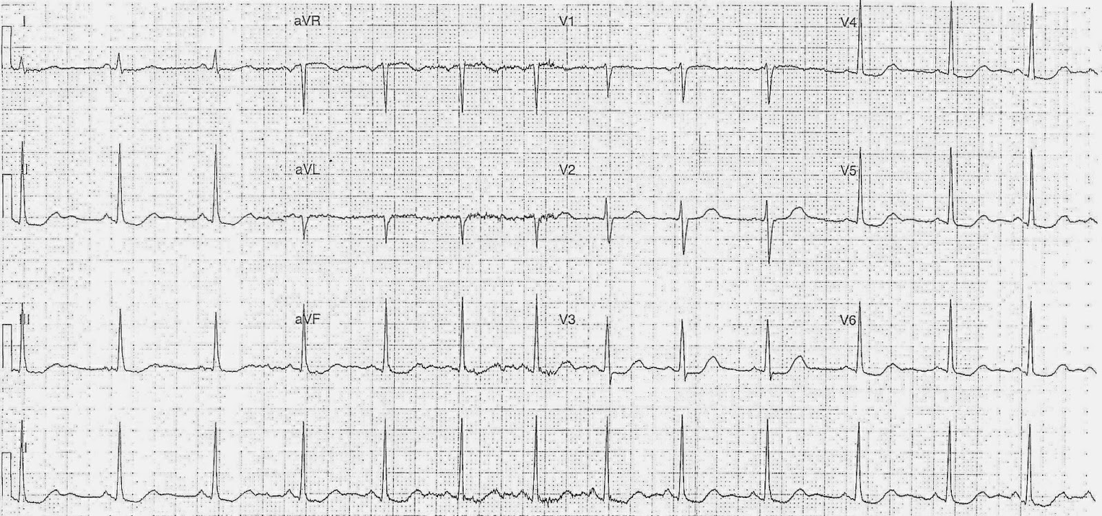 ECG of the Week: ECG of the Week - 28th September 2015 - Interpretation