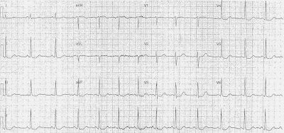 ECG of the Week: ECG of the Week - 28th September 2015 - Interpretation