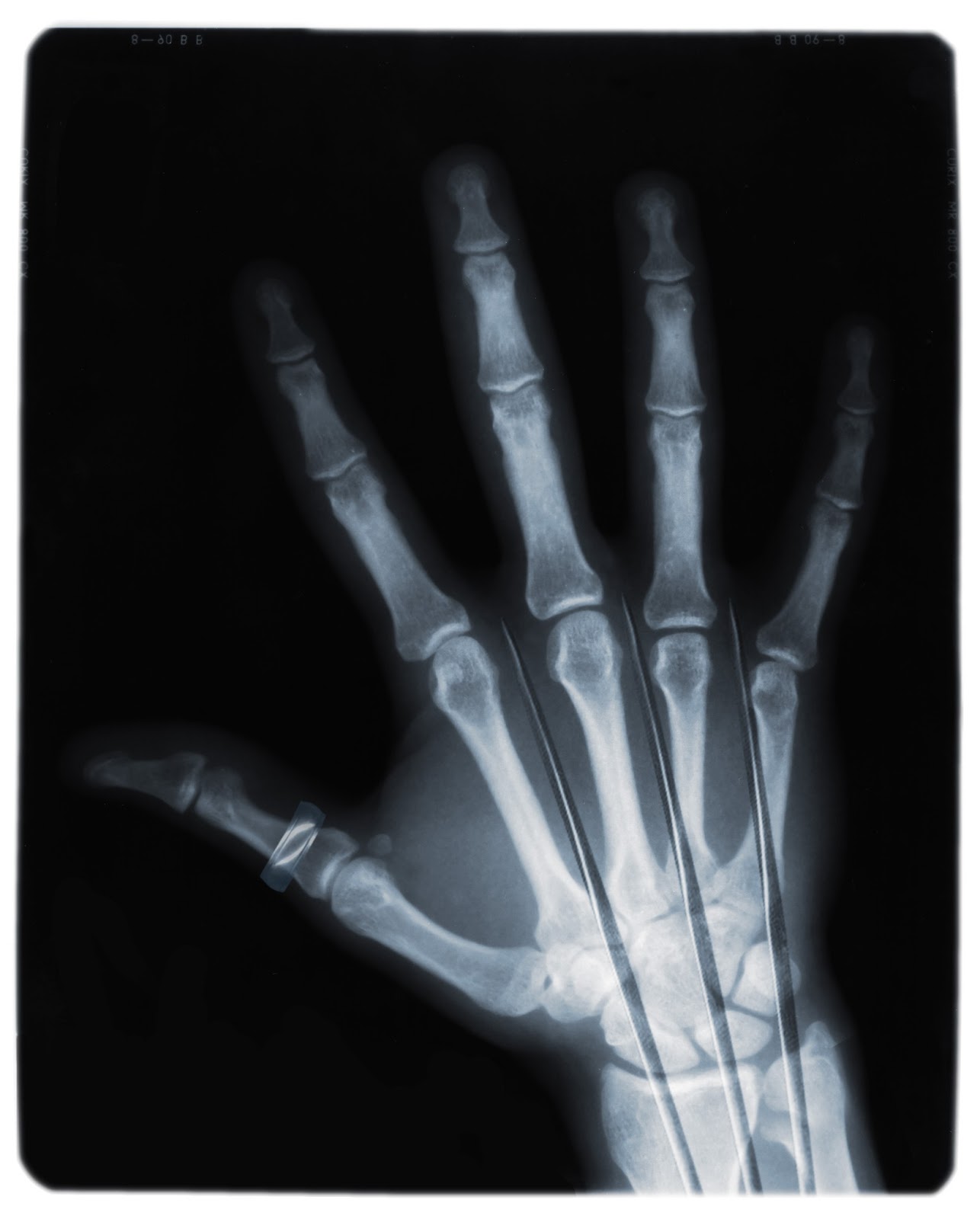 Homocystinuria: Symptoms of Homocystinuria