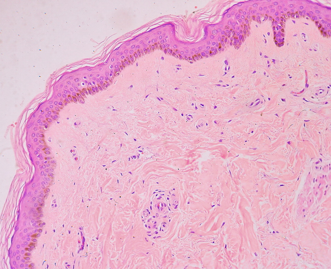 dermatopatologia para iniciantes: EPIDERME E ZONA DE MEMBRANA BASAL