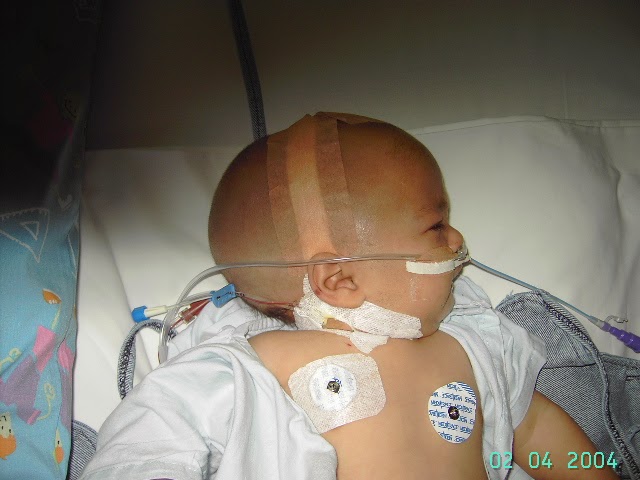 Craniosynostosis: Robert's Head: Unusual head-shape in babies