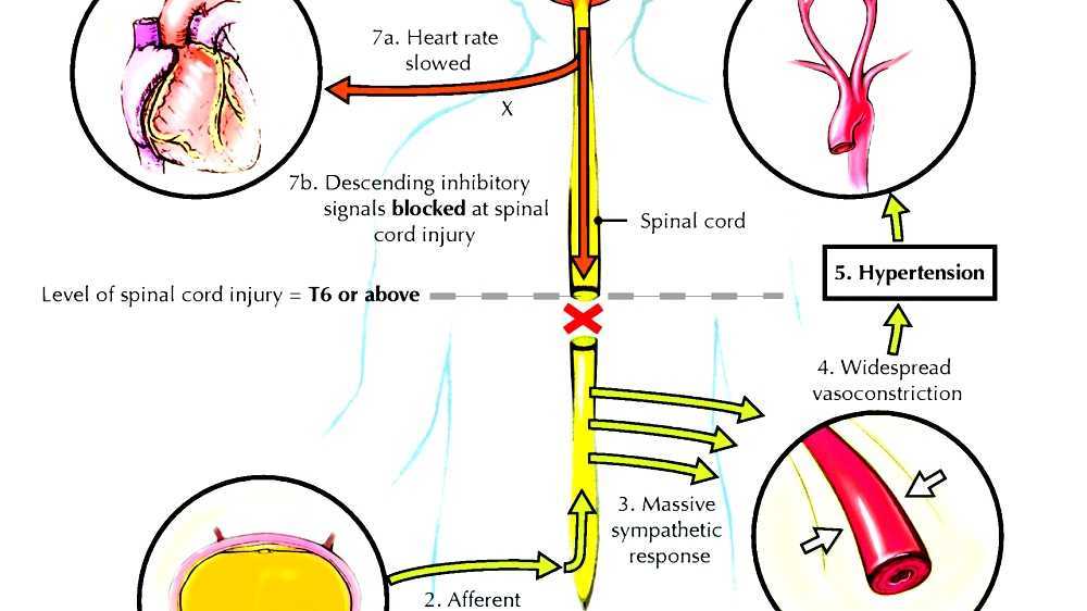 Autonomic dysreflexia