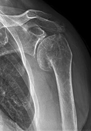 Shoulder Arthritis / Rotator Cuff Tears: causes of shoulder pain: Varus ...