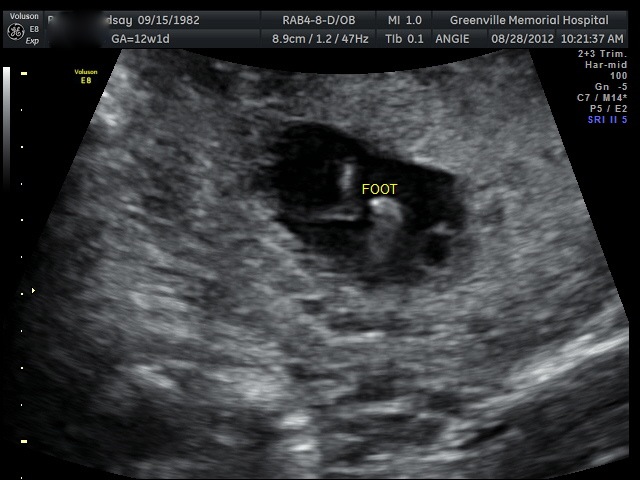 The Pregnancy – Or there and back again..: Nuchal Translucency Scan! 12 ...