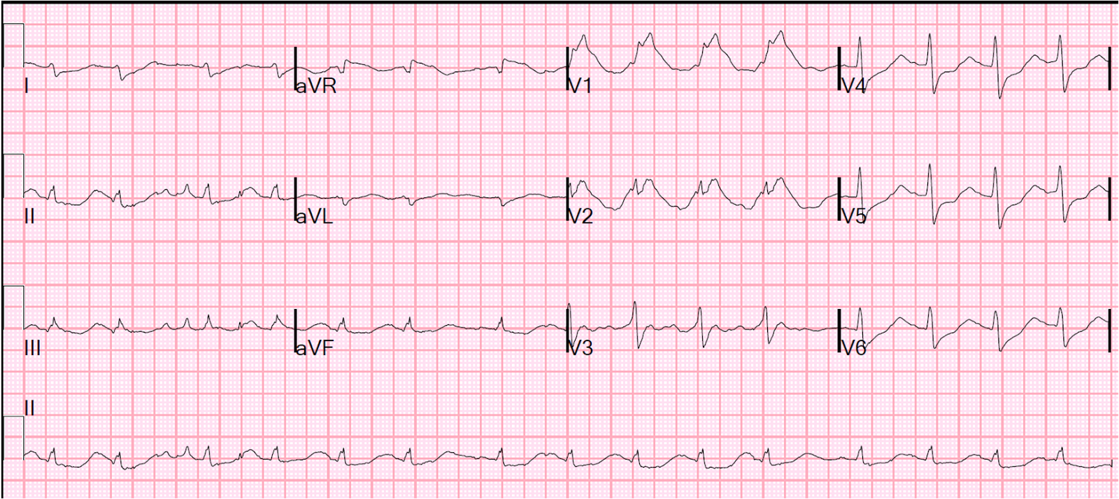 Dr. Smith's ECG Blog: Cardiac arrest, severe acidosis, and a bizarre ECG