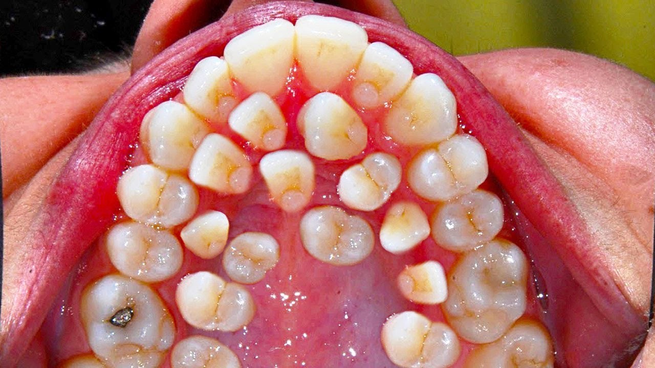 Hyperdontia