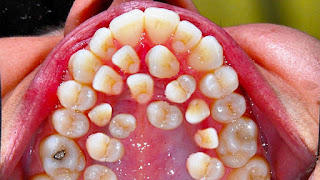 Hyperdontia