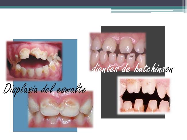 DENTAL 1001 UNAM: Macro y Microdoncia, y otras Anomalías Dentales ...