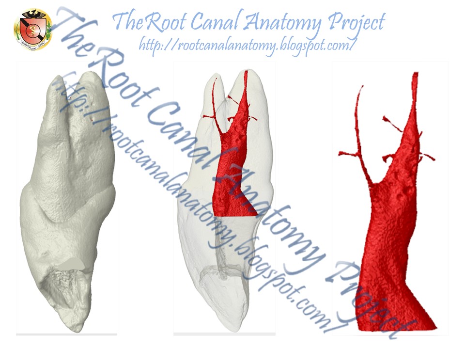 The Root Canal Anatomy Project: Two-Rooted Maxillary Central Incisor