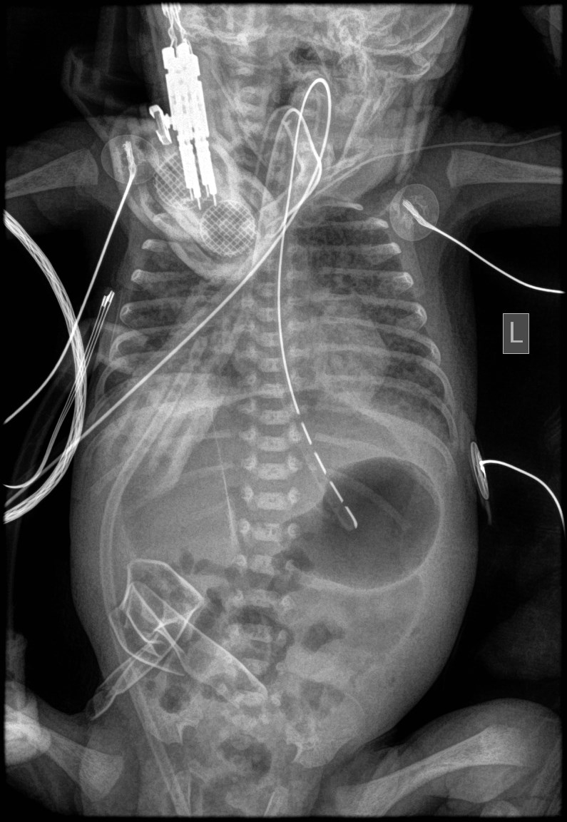 Neonate with abdominal distension