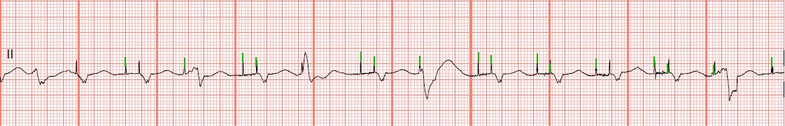 EKG Rhythm Strip Quiz 36