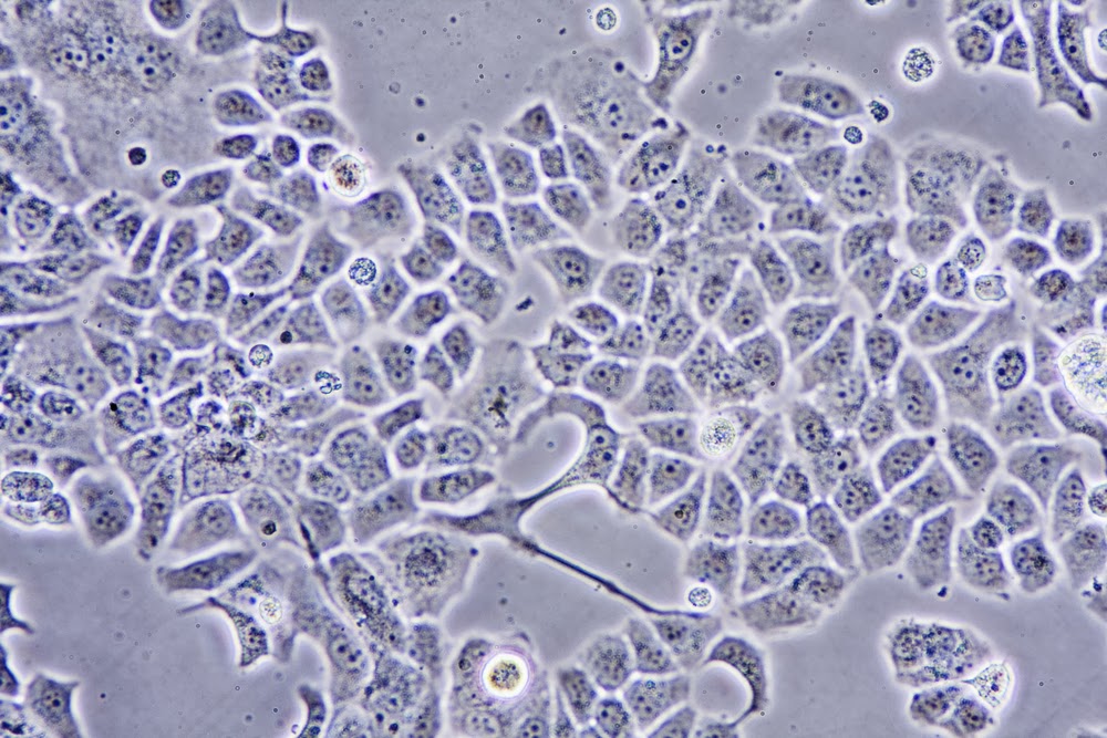 Breast cancer: Two-face ER – Europe PMC News Blog