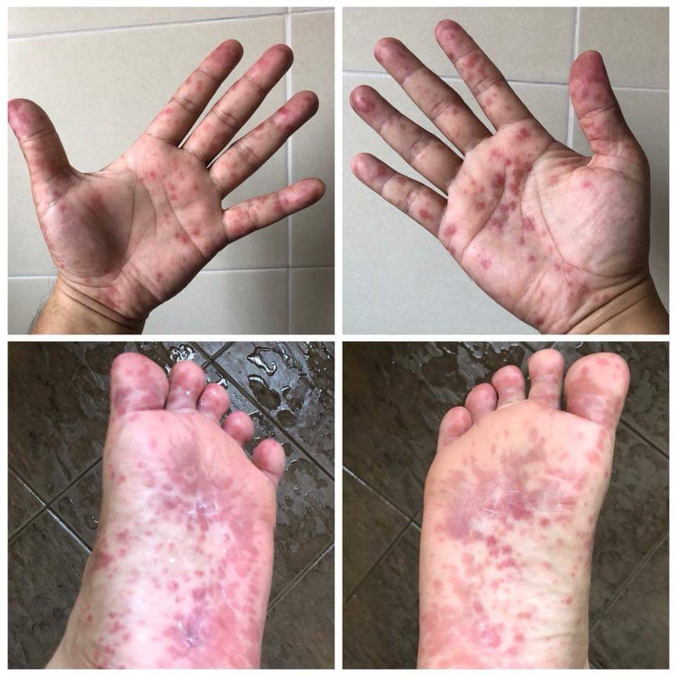 HFMD - Virus yang makin serius berjangkit di Malaysia