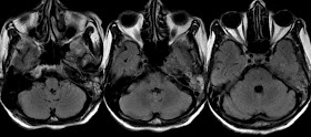Dr Balaji Anvekar FRCR: Gradenigo's syndrome MRI