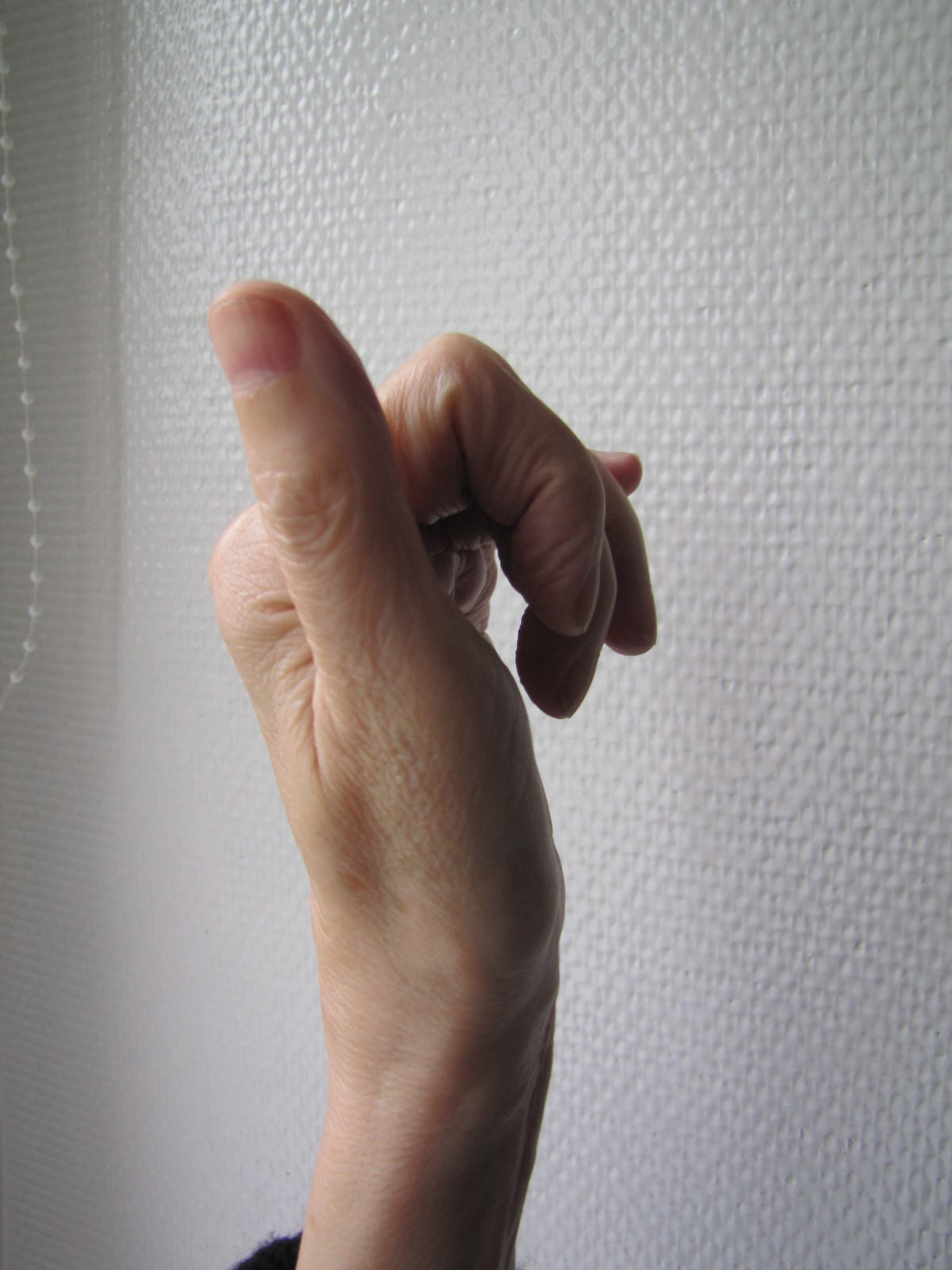 Wrist in plaster cast or finger injury - how to remove stiffness or ...