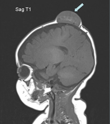 mricases: Infantile Scalp Hemangioma - MRI features