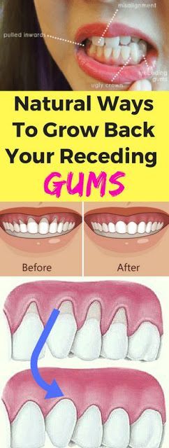 Grow Back Your Receding Gums With These Natural Remedies !... - primary ...