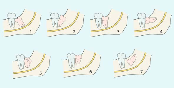 Dentistry and Medicine: Impacted Mandibular 3rd Molar Classification ...