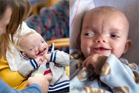 Fun Facts: Baby Dominic Proves He's Still Adorable Years After Surgery ...