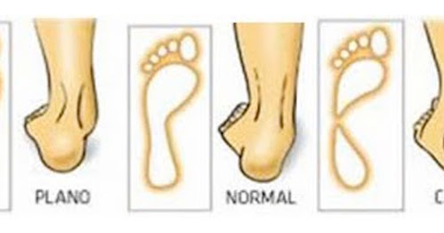 Pediatría y Educación : EFICACIA DEL TRATAMIENTO ORTOPEDICO EN PIE ...