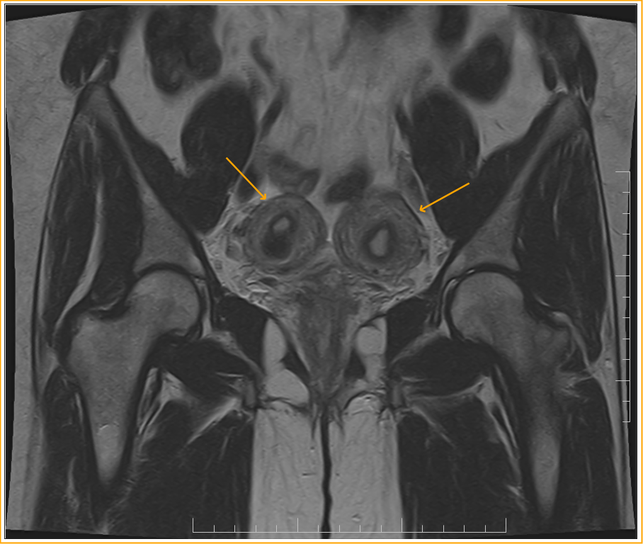 Bicornuate Uterus: MRI - Sumer's Radiology Blog