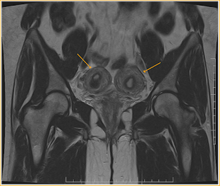 Bicornuate Uterus: MRI - Sumer's Radiology Blog