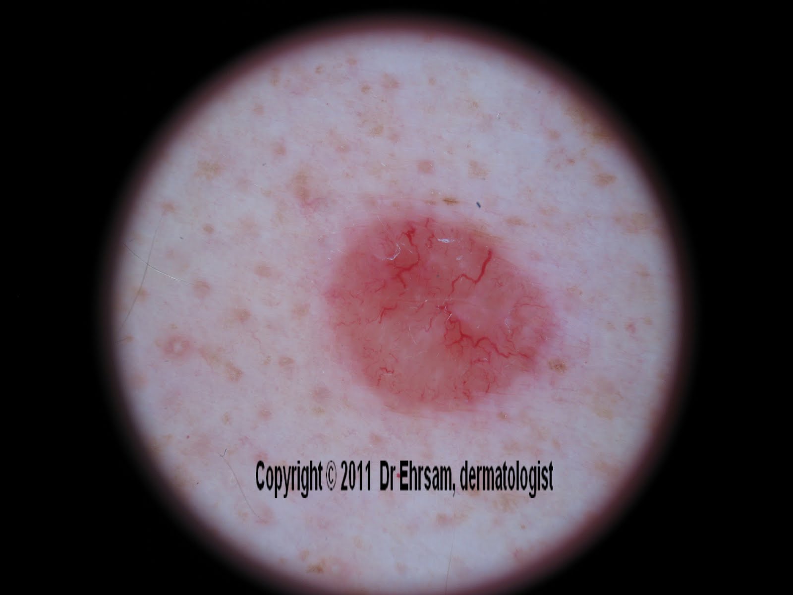 dermoscopy: Red nodule