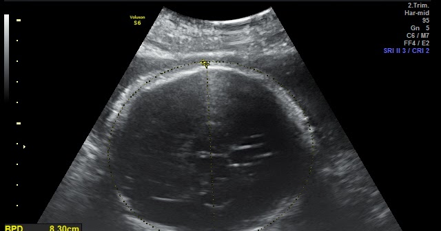Scan 5D adik baby di Klinik My Family