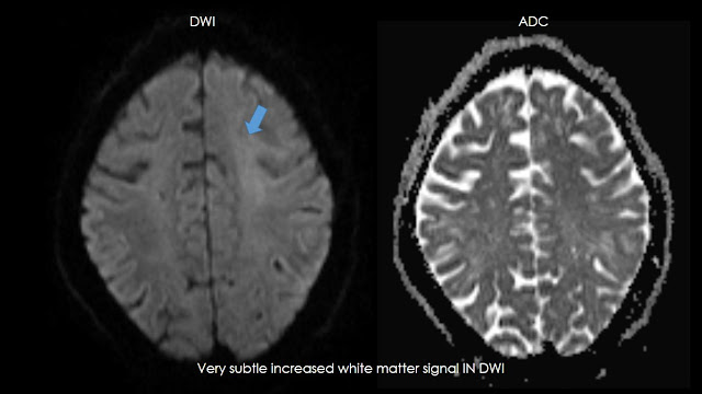 Ultimate Radiology : Diffusion negative Acute Infarct !! (False ...