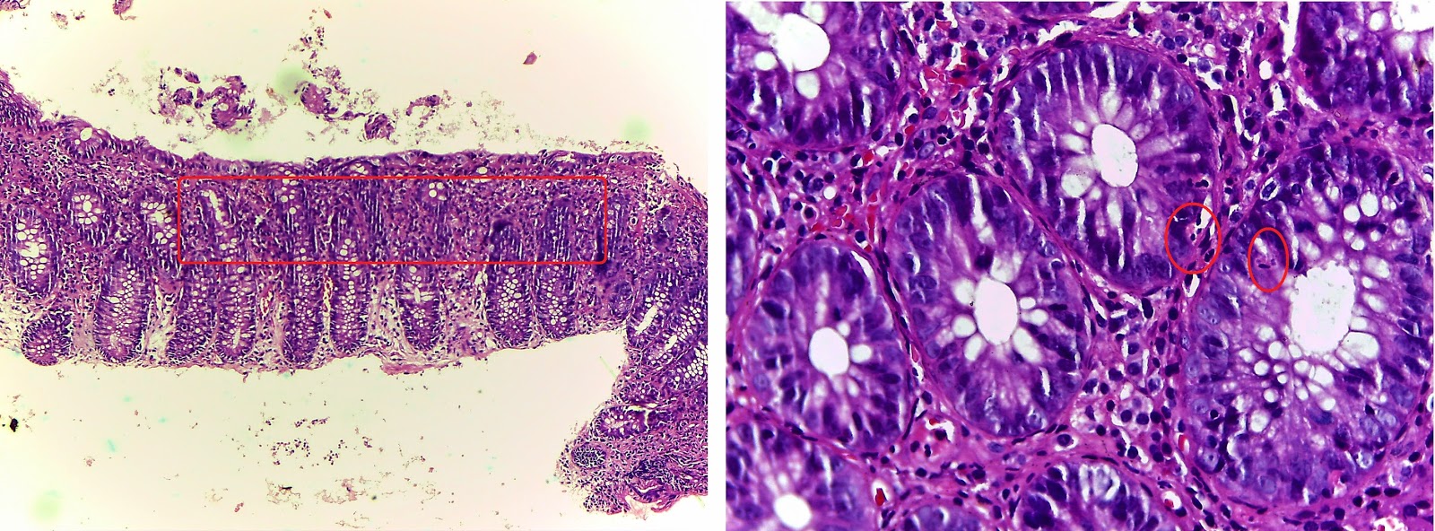 GASTROINTESTINAL AND LIVER HISTOLOGY PATHOLOGY ATLAS: COLON: INFECTIOUS ...
