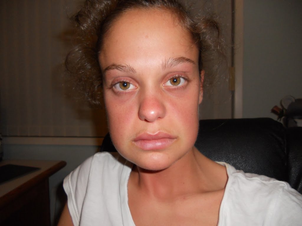 Bulimia Chipmunk Face