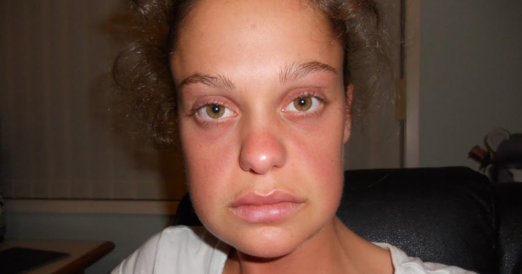 Bulimia Chipmunk Cheeks Pictures