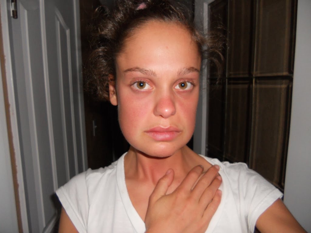 Bulimia Cheeks Before After