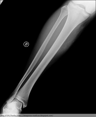 Posiciones Radiográficas de STIM: Rx Pierna (Fte)