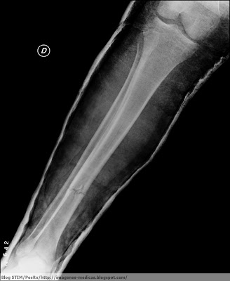 Posiciones Radiográficas de STIM: Rx Pierna (Fte)