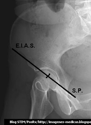 Posiciones Radiográficas de STIM: Rx de Cadera oblícua (Alar)