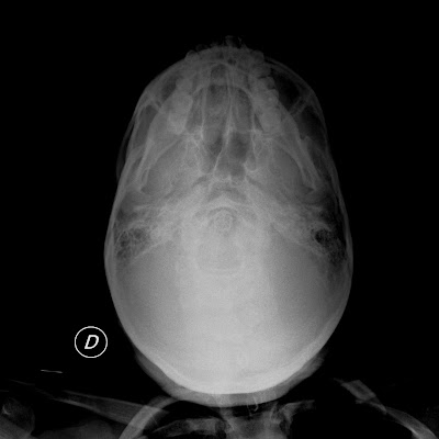 Posiciones Radiográficas de STIM: Rx Hirtz (Base de Cráneo)