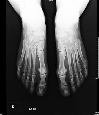 Posiciones Radiográficas de STIM: Rx Ambos Pies con Apoyo
