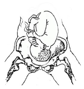 Anis Berbagi: CPD cephalopelvic disproportion (ketidakseimbangan ukuran ...