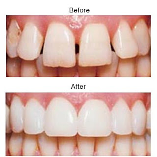All About Teeth!!!!!: dental composite