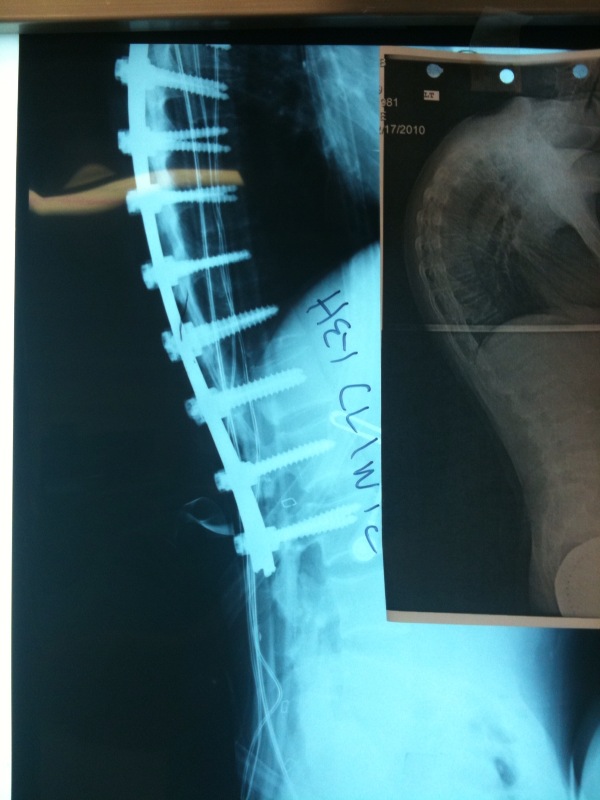Xrays before and after today's kyphosis surgery - Hey Clinic